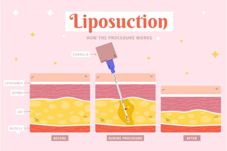 Liposuction: Preparation, Procedure, And Recovery | Hande Hospital
